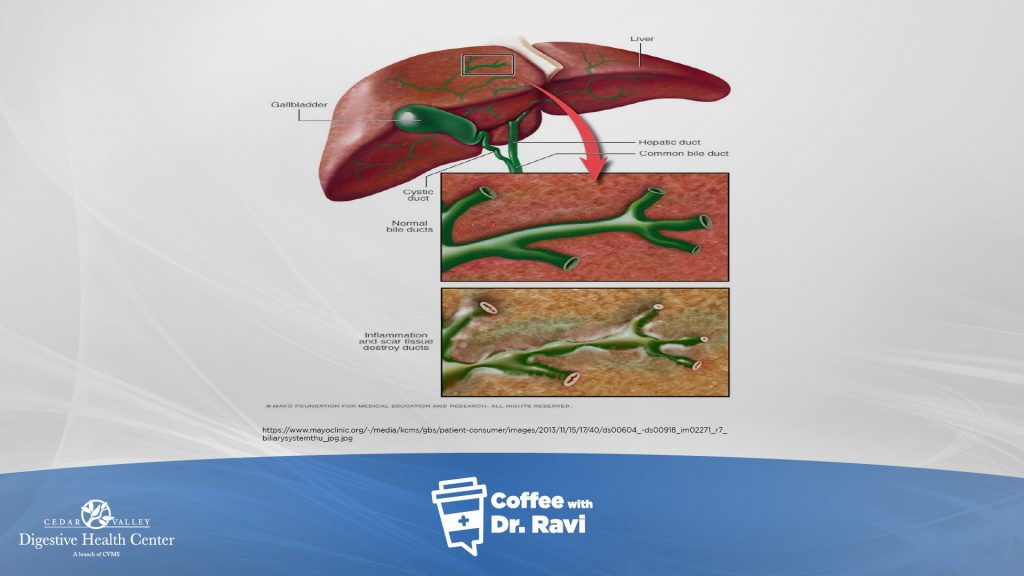 Coffee with Dr. Ravi #73: Primary Biliary Cholangitis (PBC) & Primary ...