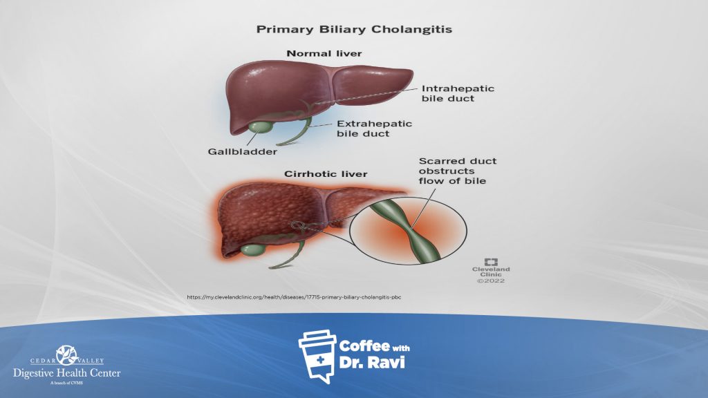 Coffee with Dr. Ravi #73: Primary Biliary Cholangitis (PBC) & Primary ...